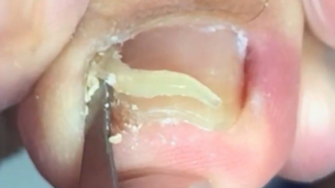 Deep and thick ingrown nails make patients uncomfortable【Dr. Zhang ...