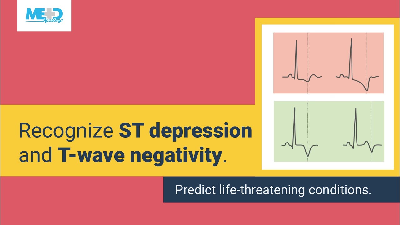 Simplifying ST depression and T-wave negativity - YouTube