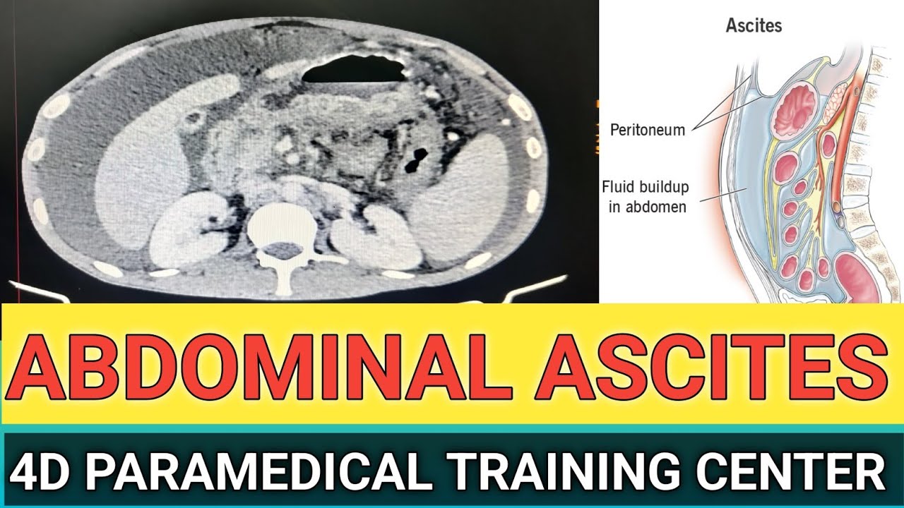 Abdominal Ascites Pathology #viralvideo #abdomen #contrast #pathology ...