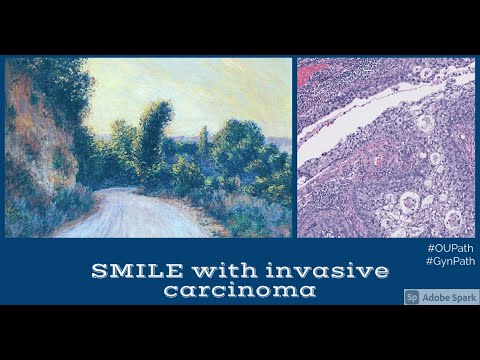 Cervical SMILE with invasive carcinoma - YouTube