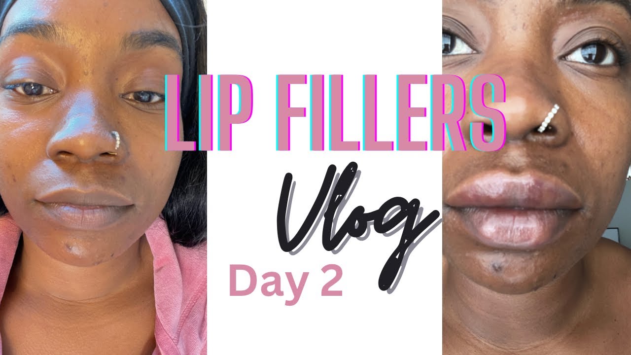 LIP FILLERS VLOG: DAY 2 | BLACK GIRLS GET FILLERS TOO!! + TELFAR BAG ...