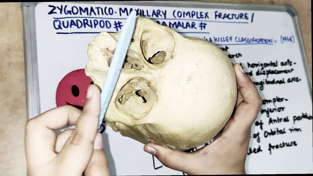 zmc (zygomatic complex) fracture lecture - classification - YouTube