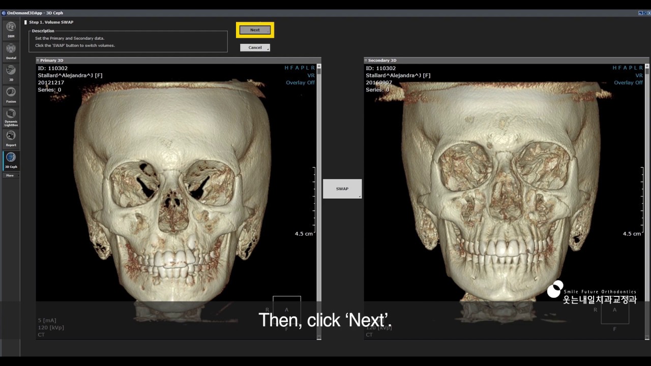 OnDemand3D '3DCeph Module' (1/3) - YouTube