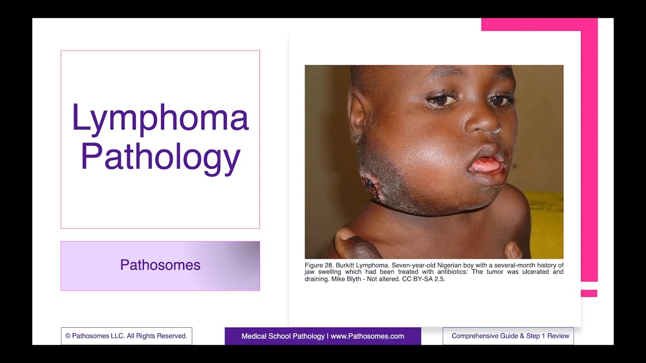 Lymphoma Pathology | Comprehensive Guide & Step 1 Review | Pathology ...