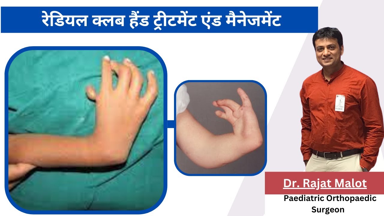 Radial Club Hand | रेडियल क्लब हैंड ट्रीटमेंट एंड मैनेजमेंट | Dr Rajat ...