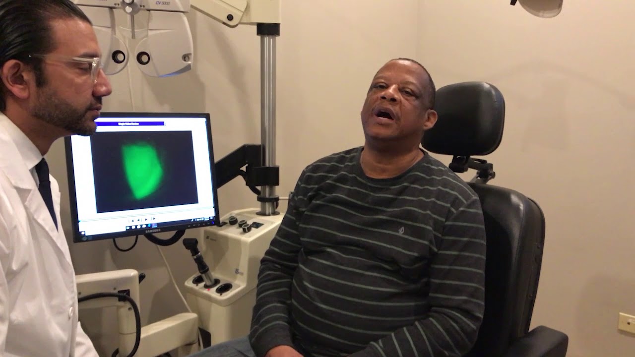 Pellucid Marginal Degeneration (PMD) and Scleral Lenses at Village ...