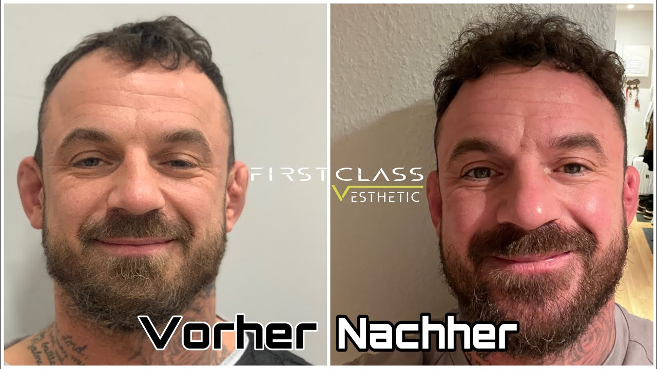 Haartransplantation Erfahrungen in Istanbul | FirstClass-Esthetic - YouTube