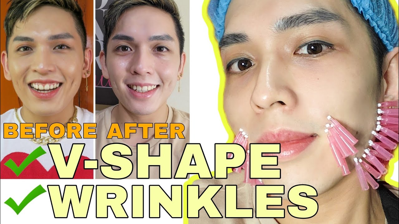 PAMPALIIT (V-SHAPE) NG FACE + TANGGAL WRINKLES? THREAD LIFTING ...