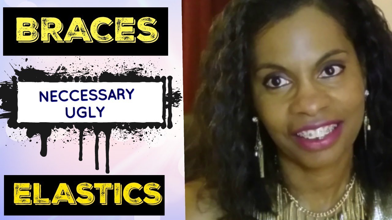 Adult Braces Journey Elastics and Stoppers The Down Side. - YouTube