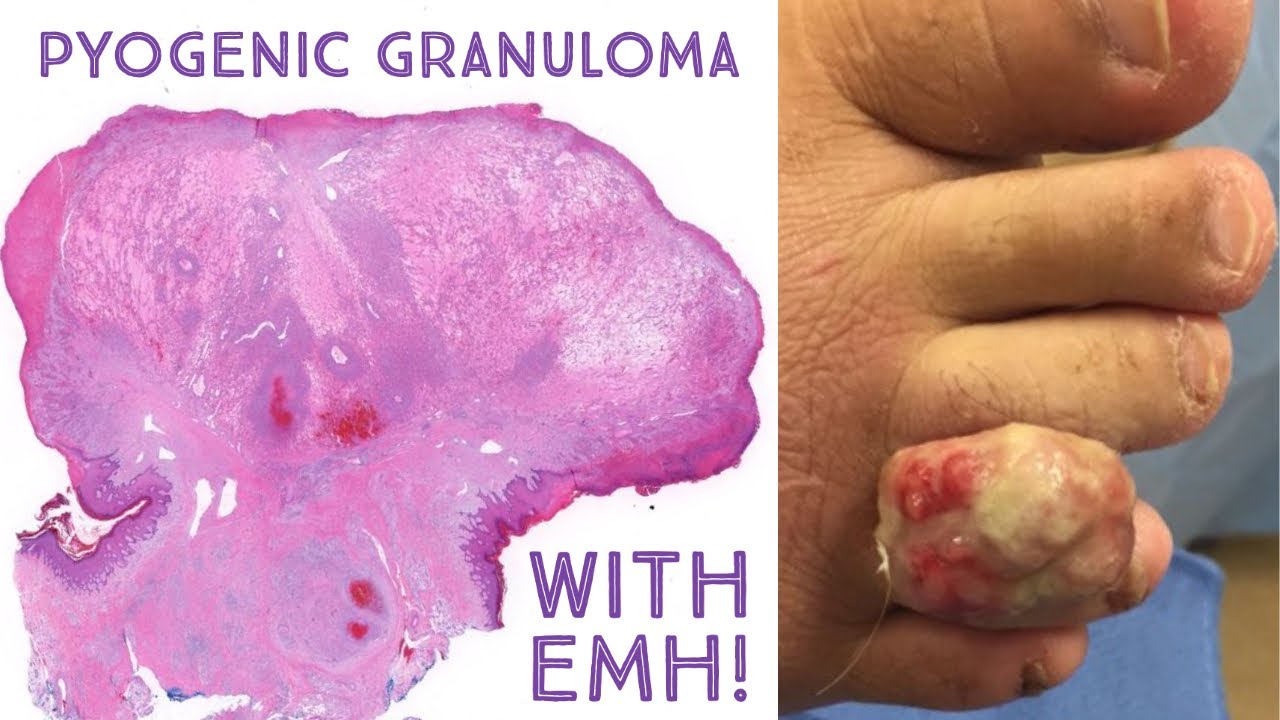 HUGE Pyogenic Granuloma (lobular capillary hemangioma) + extramedullary ...