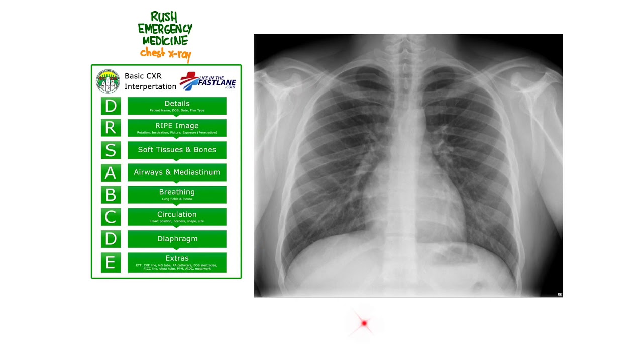 CXR A Systematic Approach YouTube cxr-a-systematic-approach-youtube