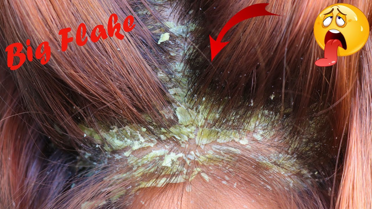 Big Dandruff Flakes | Scratching psoriasis Itchy dandruff scalp #607 ...