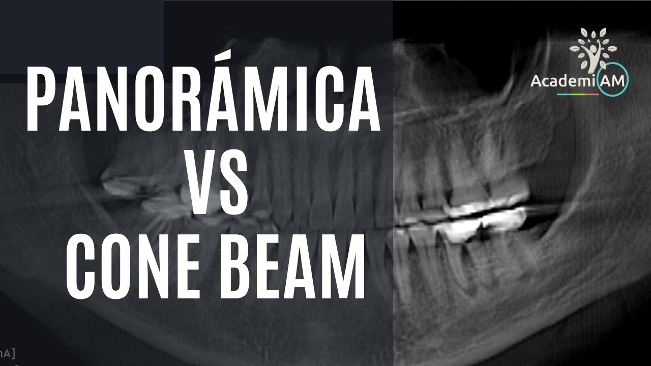 Radiografía PANORÁMICA vs CONE BEAM. ¿Sabes su eficacia diagnóstica? - YouTube