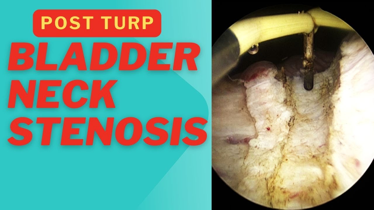 Post TURP Bladder Neck Stenosis | BNI | TURP | Bladder Neck Incision ...