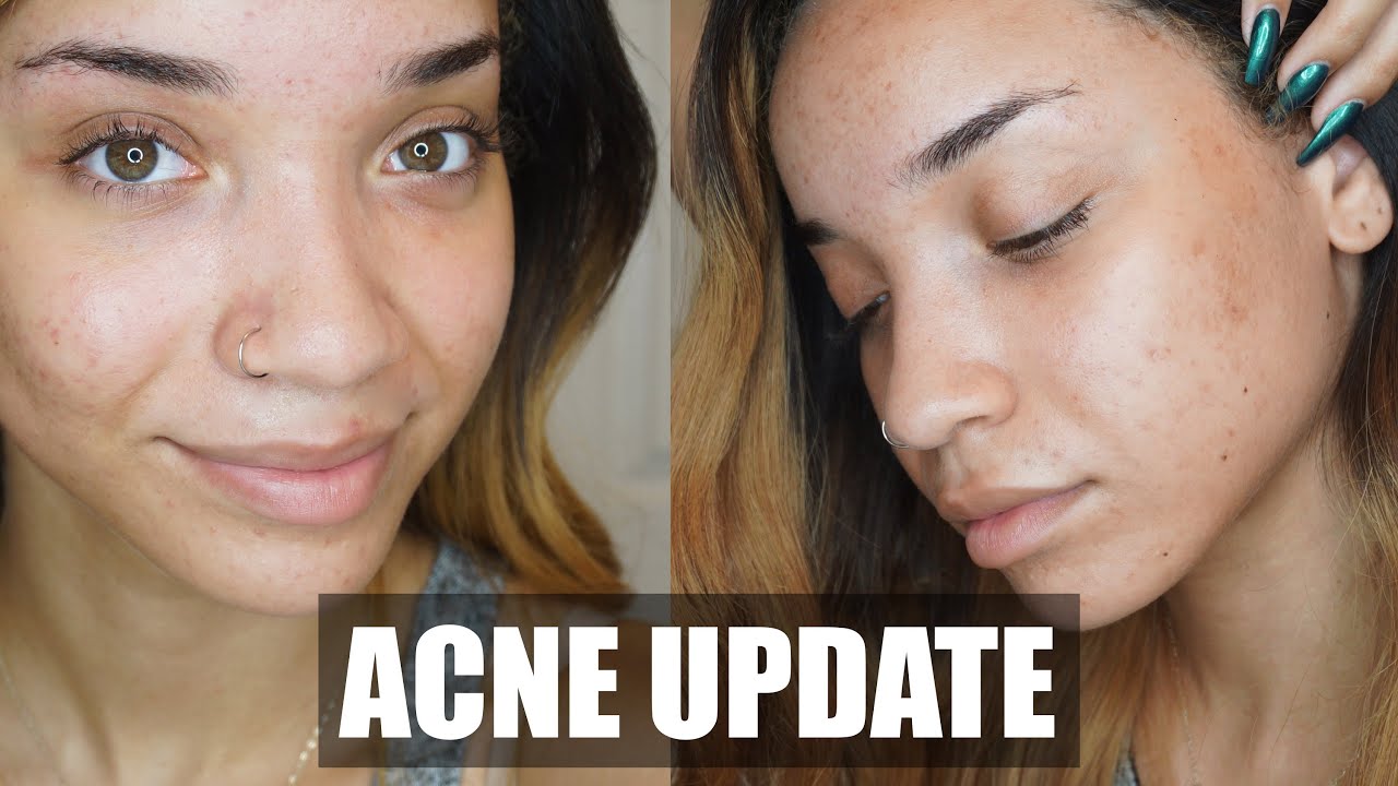 SKINCARE| Acne.org 6 Month Update - YouTube