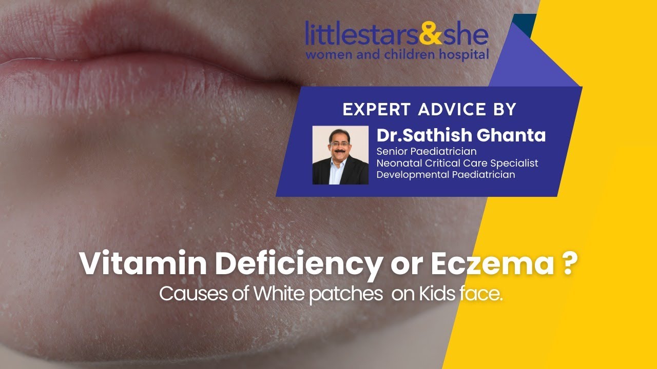 White Patches on Child's Skin?? Causes & Care Explained | Dr.Satish ...