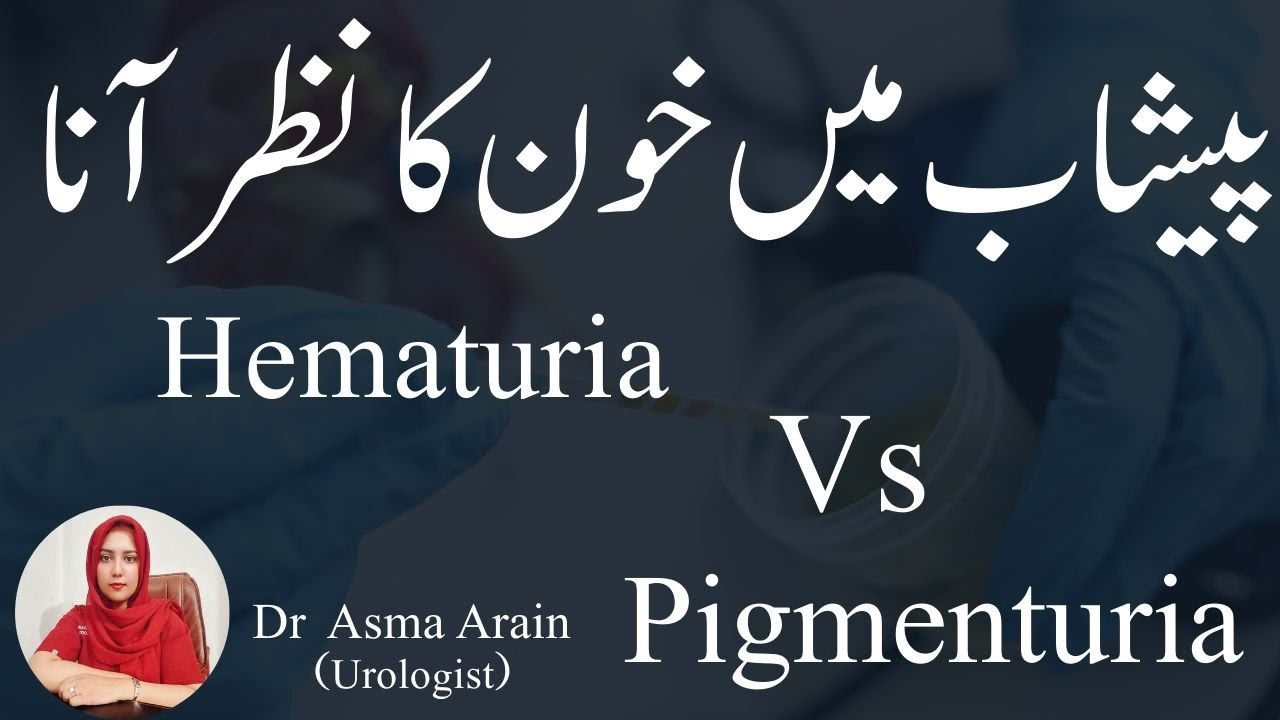 What is Gross Hematuria and PIGMENTURIA | Gross Hematuria vs ...