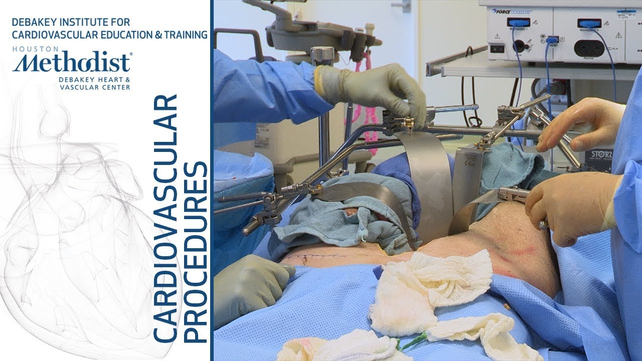 Entering the "Redo" Abdomen & Setting-up the Thompson Retractor ...