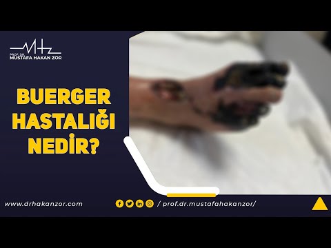 Buerger (Budama) Hastalığı Nedir? Buerger Hastalığı Tedavisi Nedir?