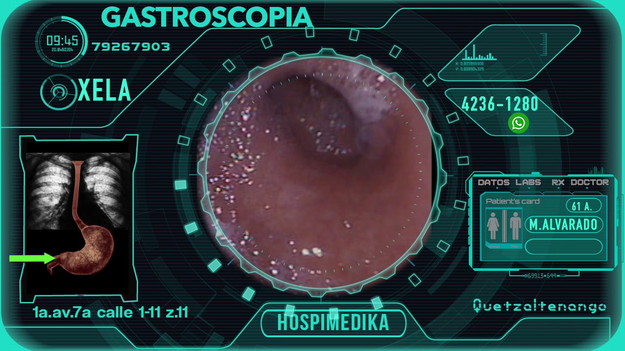 ENDOSCOPIA GASTRICA - YouTube