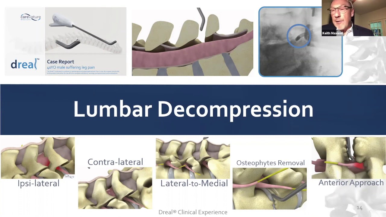 Keith Maxwell, MD Zoom Meeting Presentation on Dreal® Technology 13 May ...