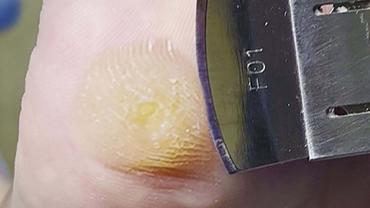 Stubborn nails on the soles of the feet, scraped off bit by bit【Xue ...