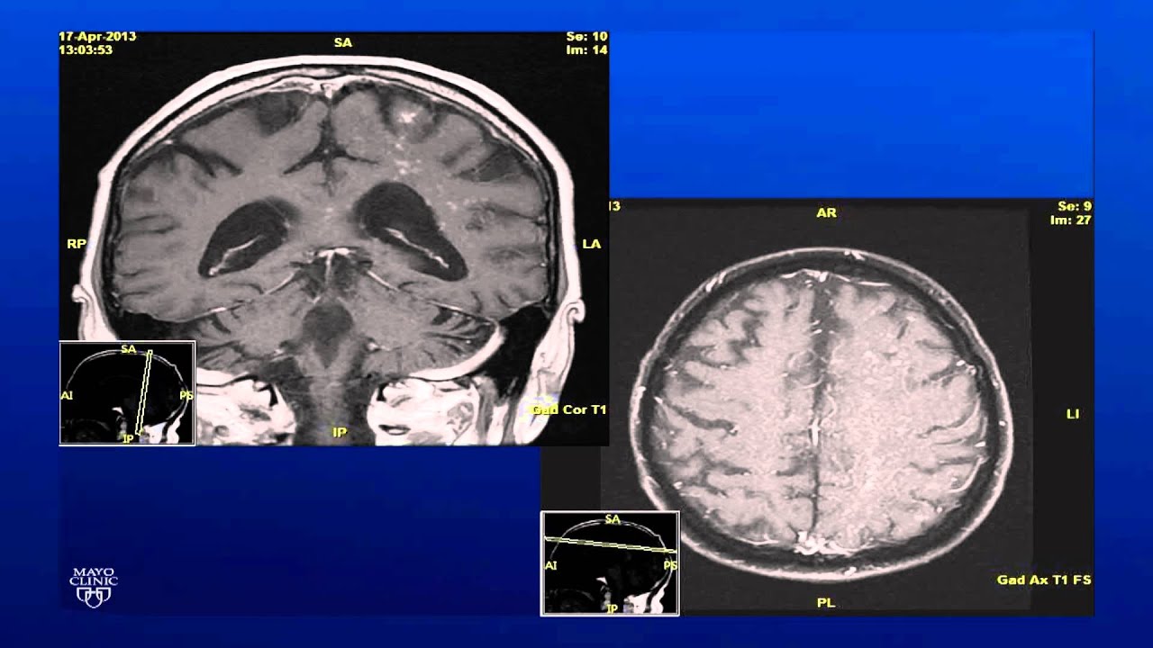 Unilateral Panuveitis - YouTube