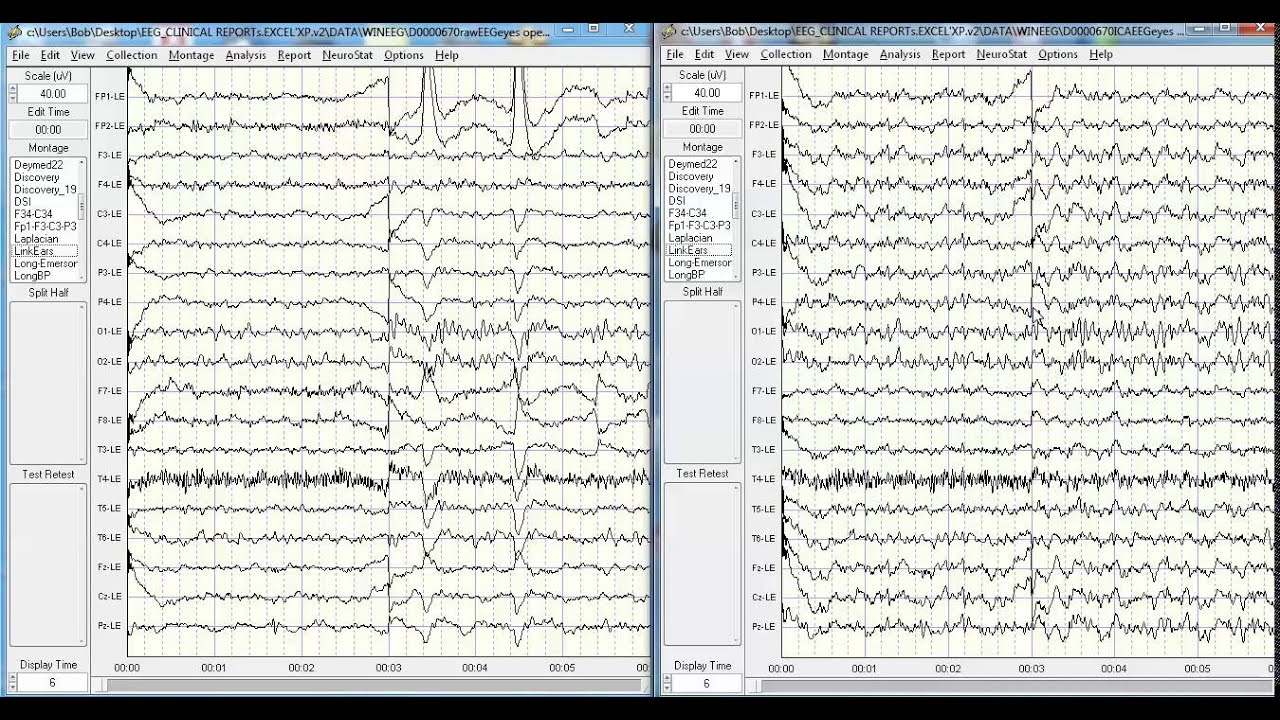 ICA Reconstruction to Remove Artifact Adulterates EEG Phase & Coherence ...