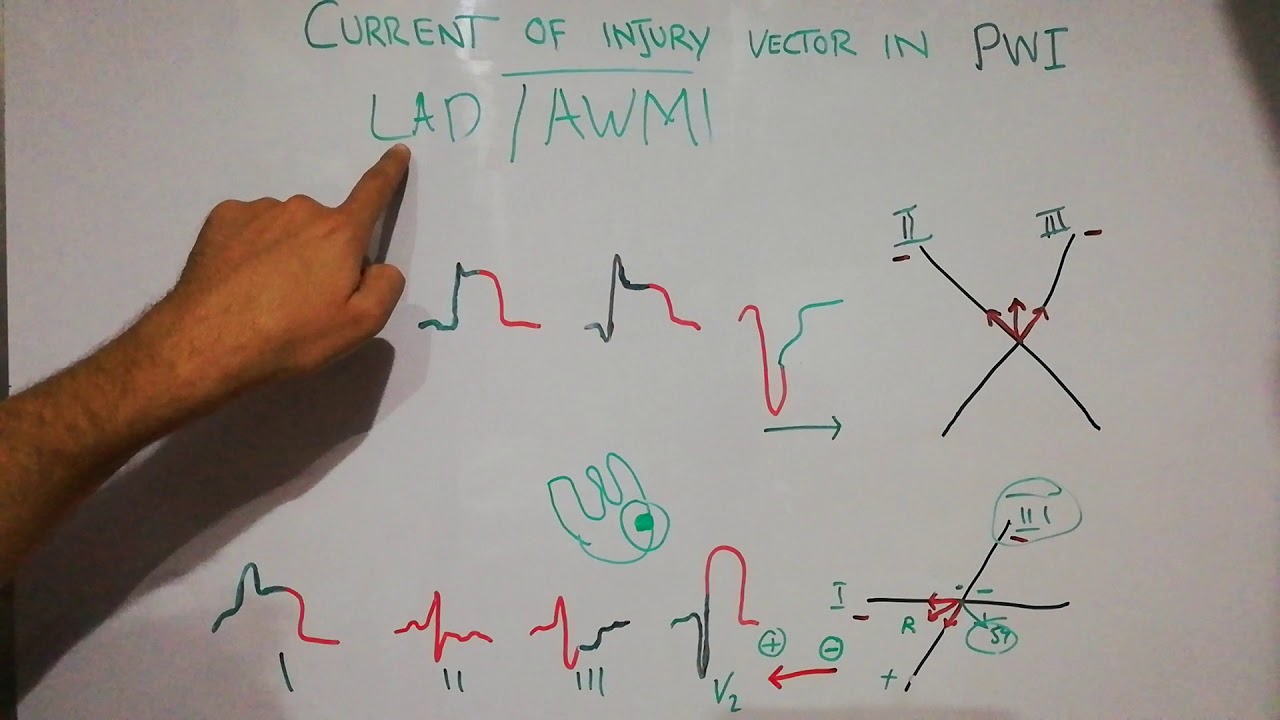 CVS 43 || Current of injury | posterior wall myocardial infarction ...
