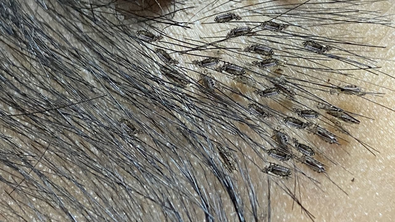How Head Lice Removed By Hand - Head Lice Removing All From Black Hair ...