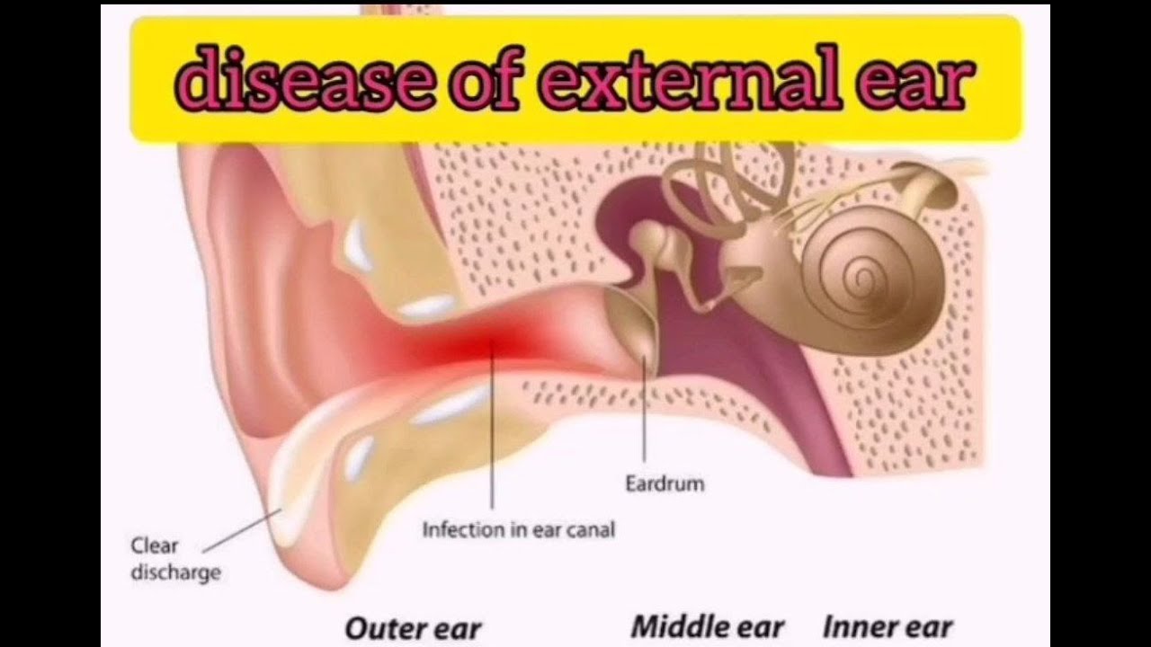 Diseases of external ear - YouTube