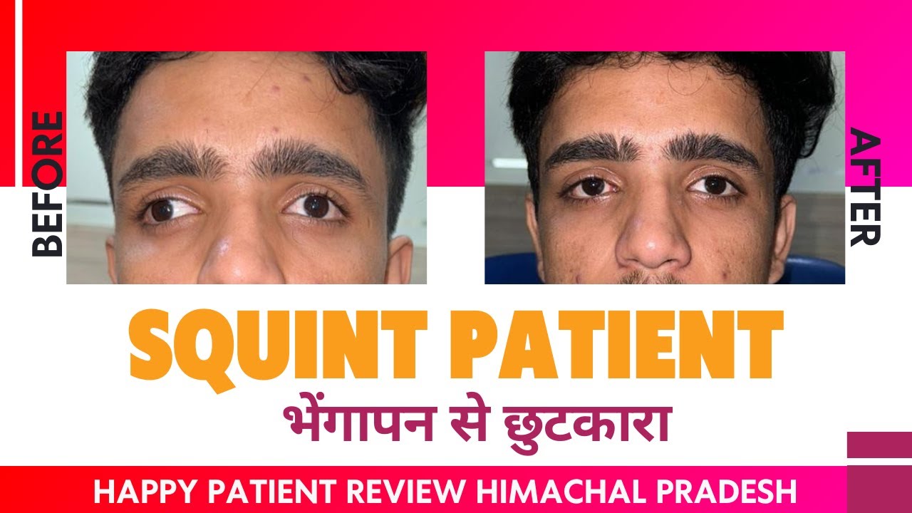 Strabismus Surgery Or Squint Surgery Treatment Or Crossed Eyes Happy ...