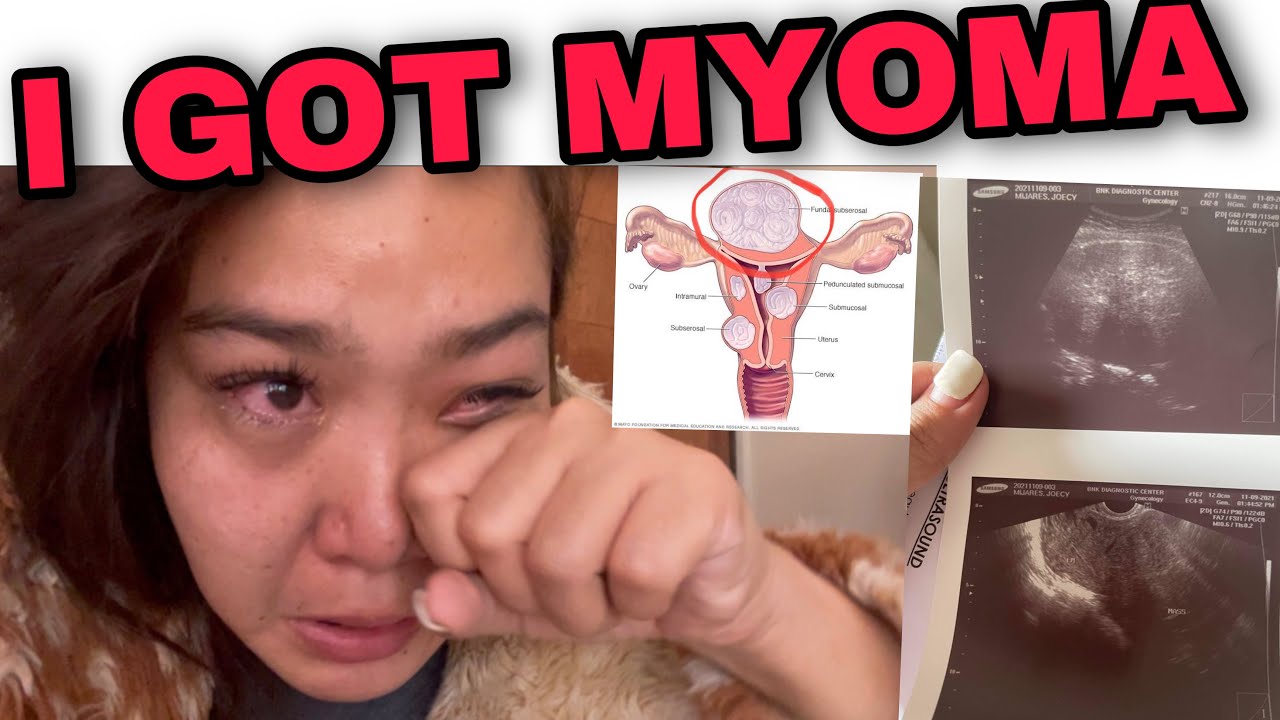 I GOT MYOMA (Life Update) Jaygee Weekly Series - YouTube