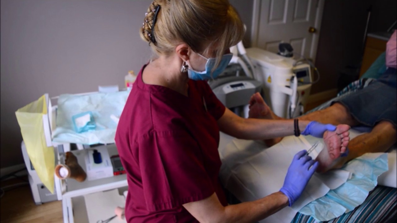 Volumising Foot Fillers for Painful Soles and Toes - YouTube