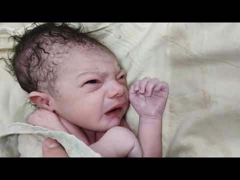 Newborn baby having a Big caput due to prolonged labour after birth ...