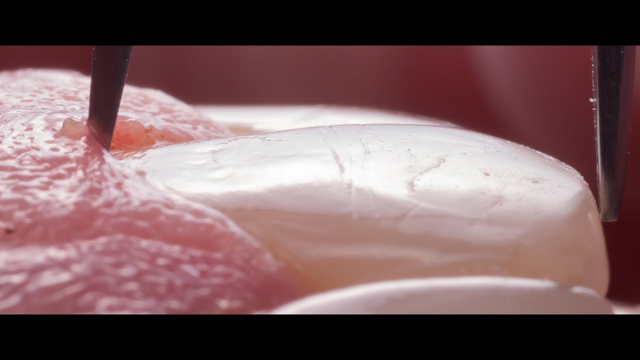 Crown Lengthening Tips - YouTube