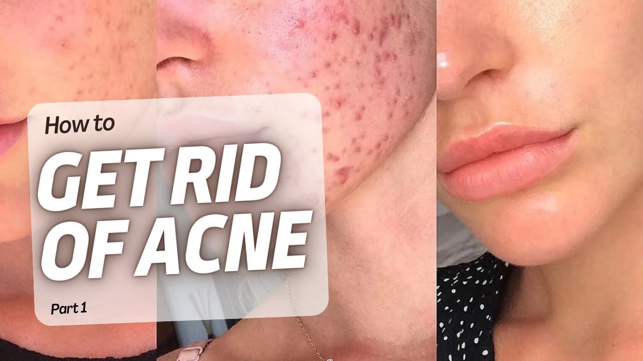 Acne Be Gone Top Home Remedies To Banish Acne How To Get Rid Of Acne