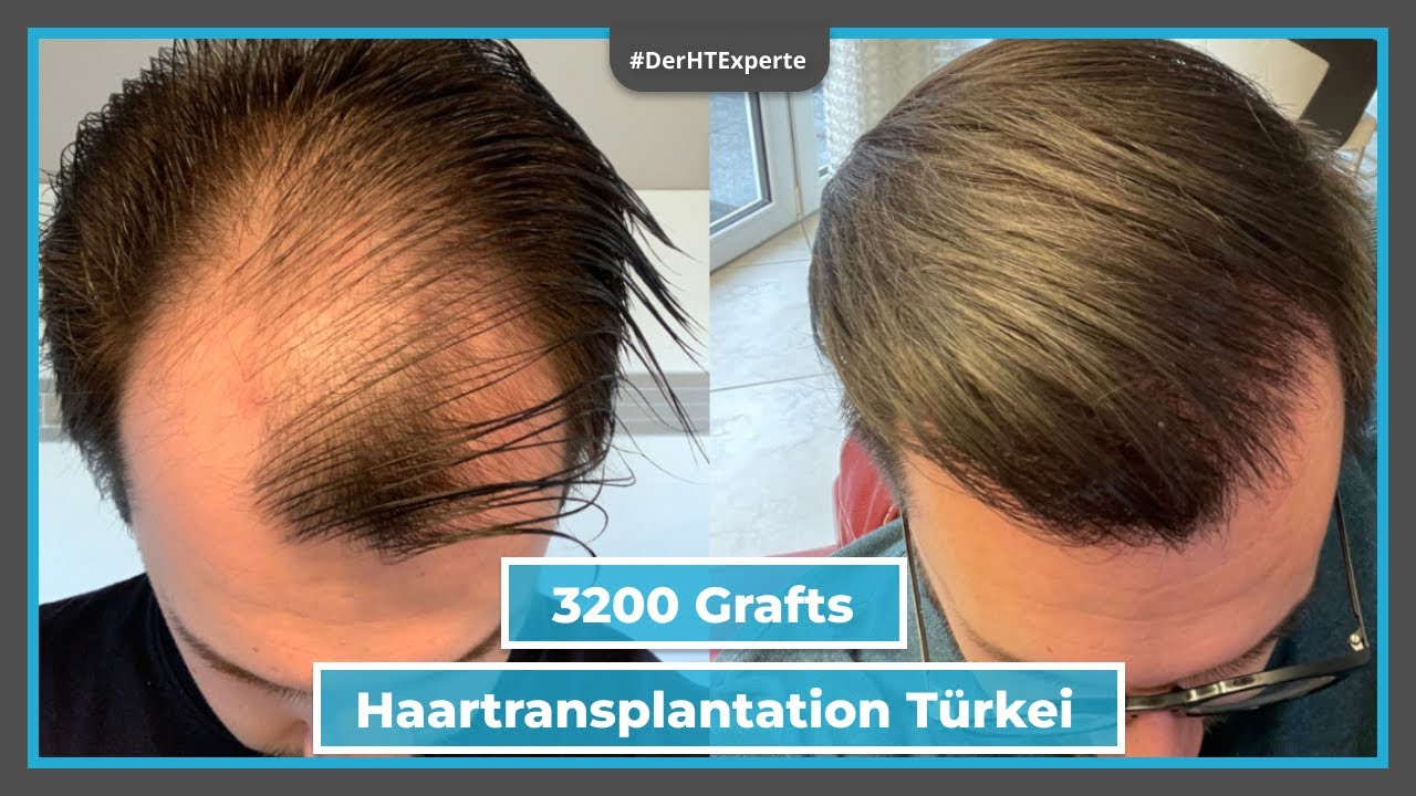 Haartransplantation Türkei Vorher - Nachher mit 3200 Grafts [Dr ...