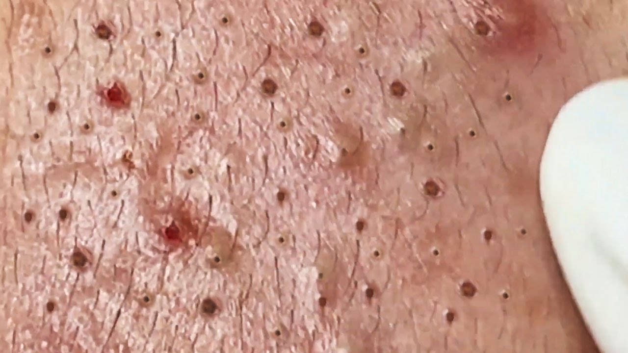 Blackhead removal Video #82 #Blackheads #blackheadsremoval #sebum - YouTube
