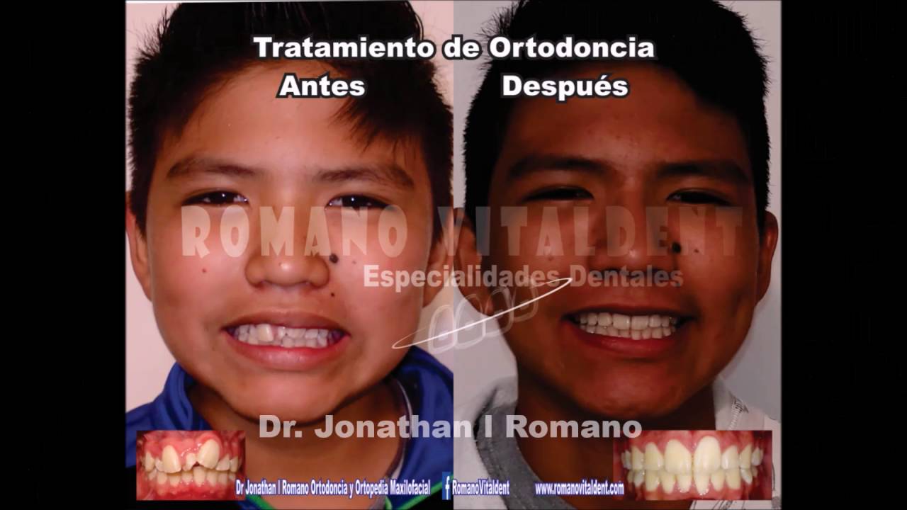 Caso de Extracción de un Diente Supernumerario con Excelentes ...