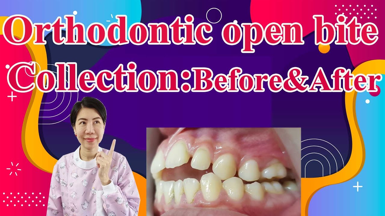 Orthodontic open bite correction: Before and After - YouTube