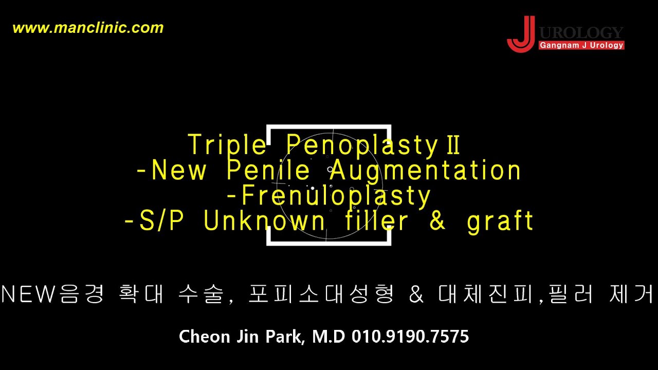 Triple Penoplasty Ⅱ -New Penile Augmentation- Frenuloplasty -S/P ...