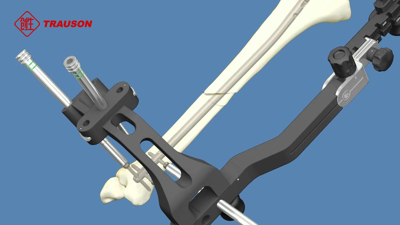 Tibia Nail II - YouTube