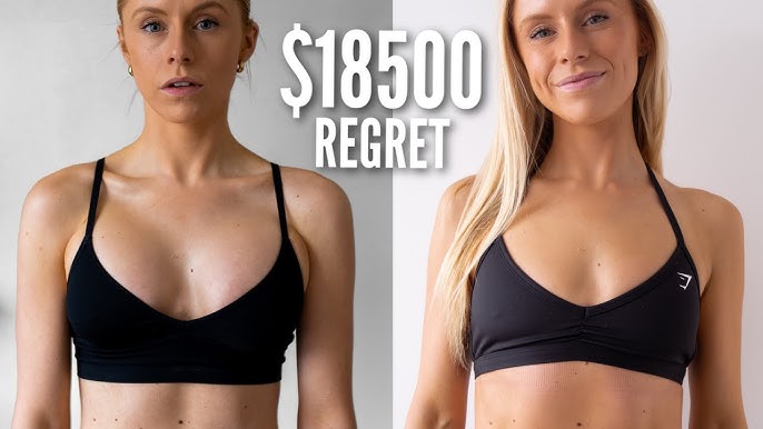 Breast Implants After Weight Loss
