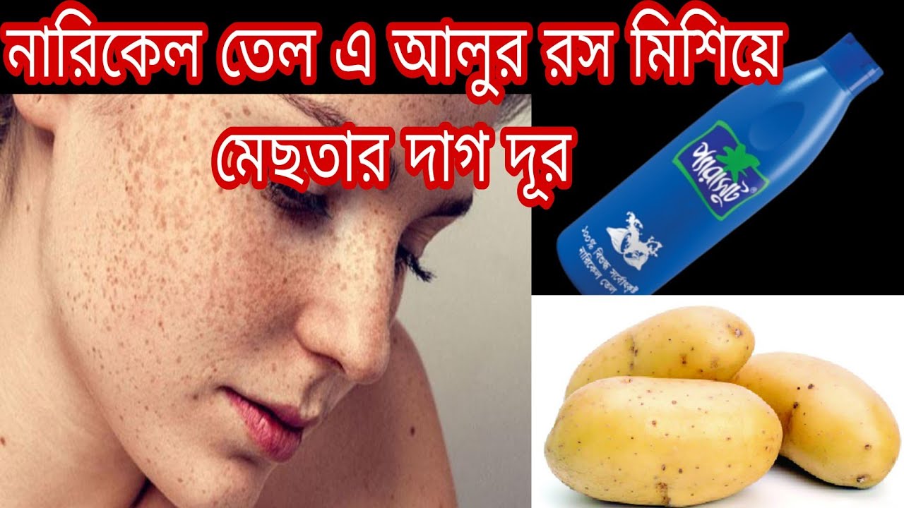 আলুর রস এ নারিকেল তেল দিয়ে খুব তাড়াতাড়ি মেছতা উঠে দাগহীন ফর্সা ত্বক ...