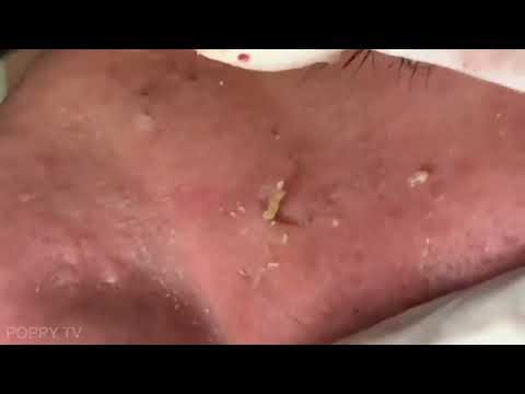 Deep Blackheads Removal from Cheeks and Nose Best Pimple Popping Videos ...