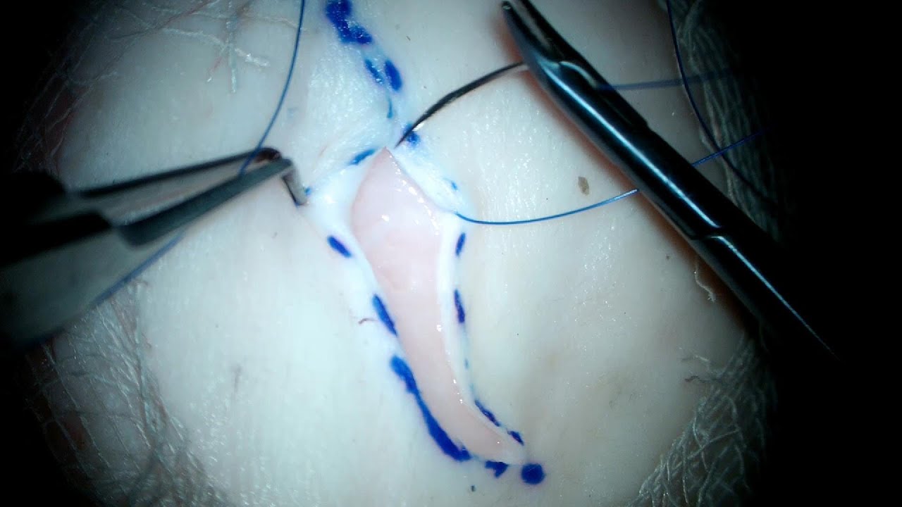 Subcuticular Sutures Technique - YouTube