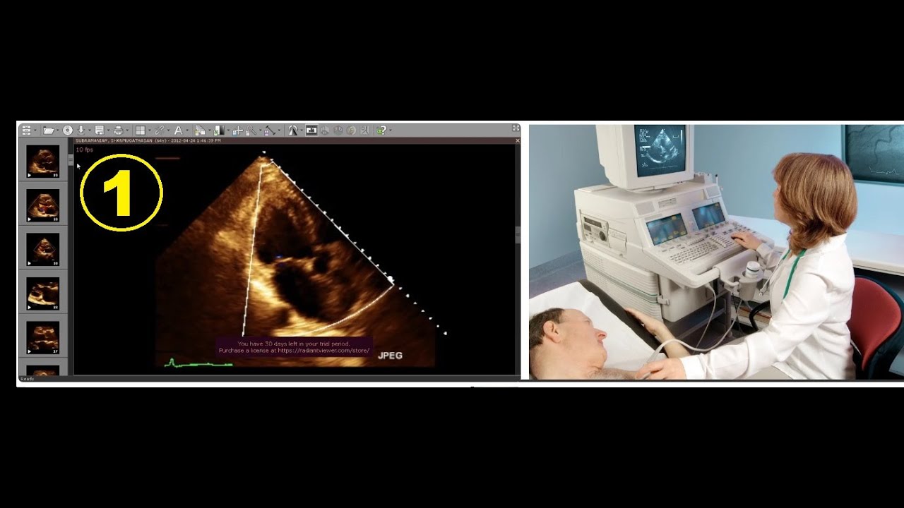EchoCardioGraphy for a 64 yrs old patient who had SVT attack ...