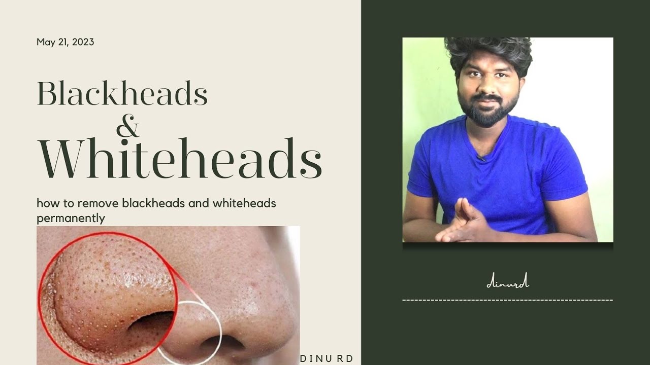 How To Remove Blackheads Fast And Easy | Get Rid Of Blackheads With This Easy Tutorial! | Dinu ...