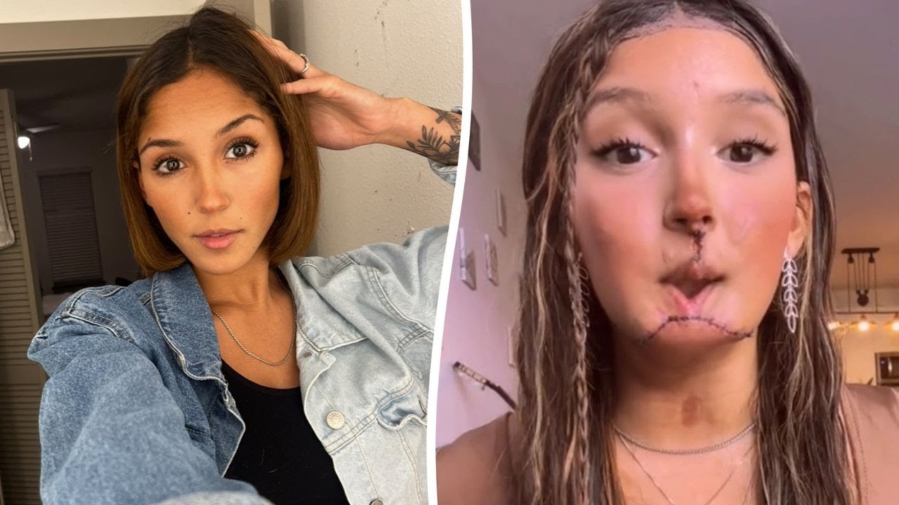 Suicide attempt survivor, 23, with gunshot head wound becomes voice for ...